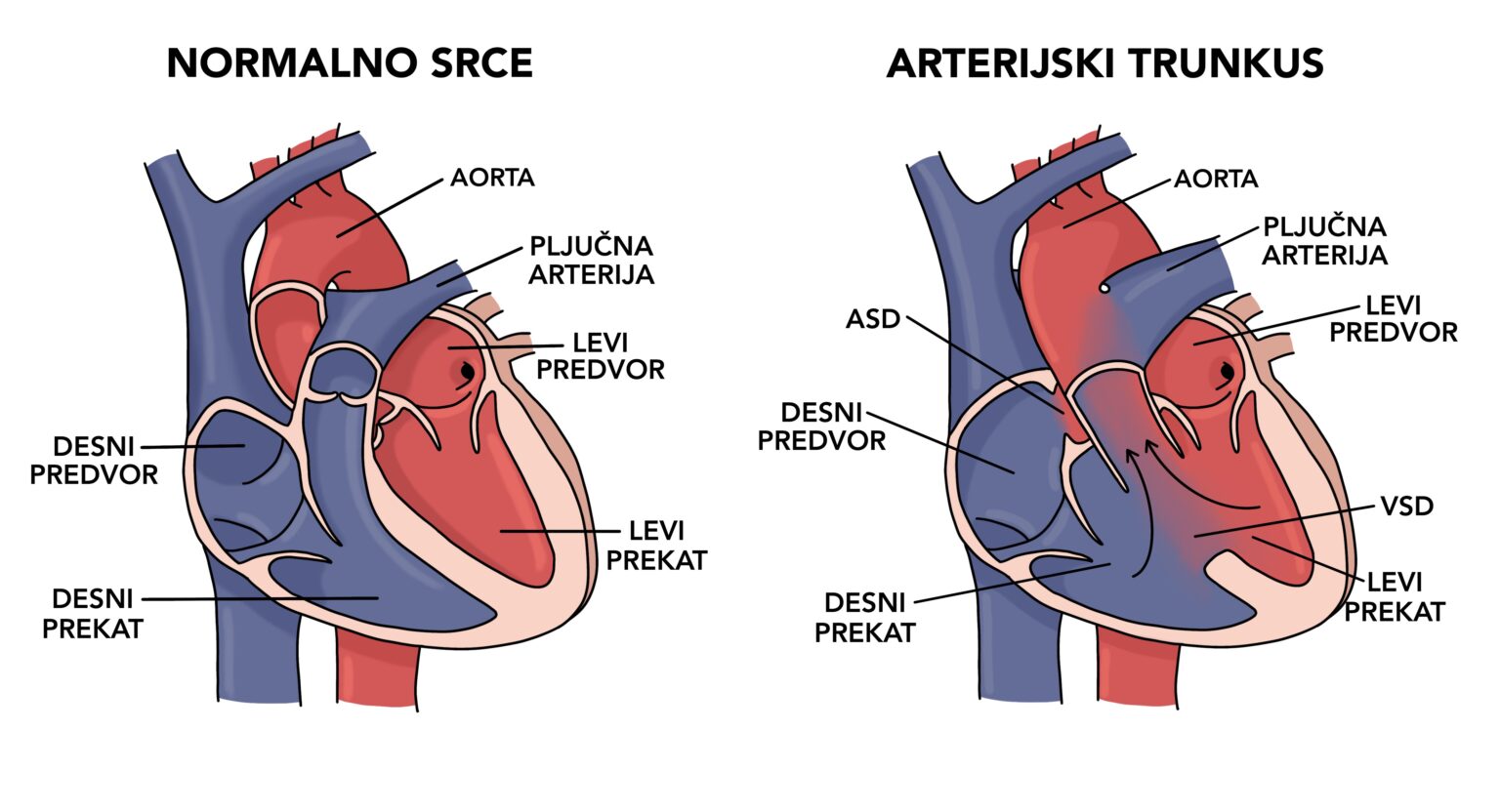 ARTERIJSKI TRUNKUS